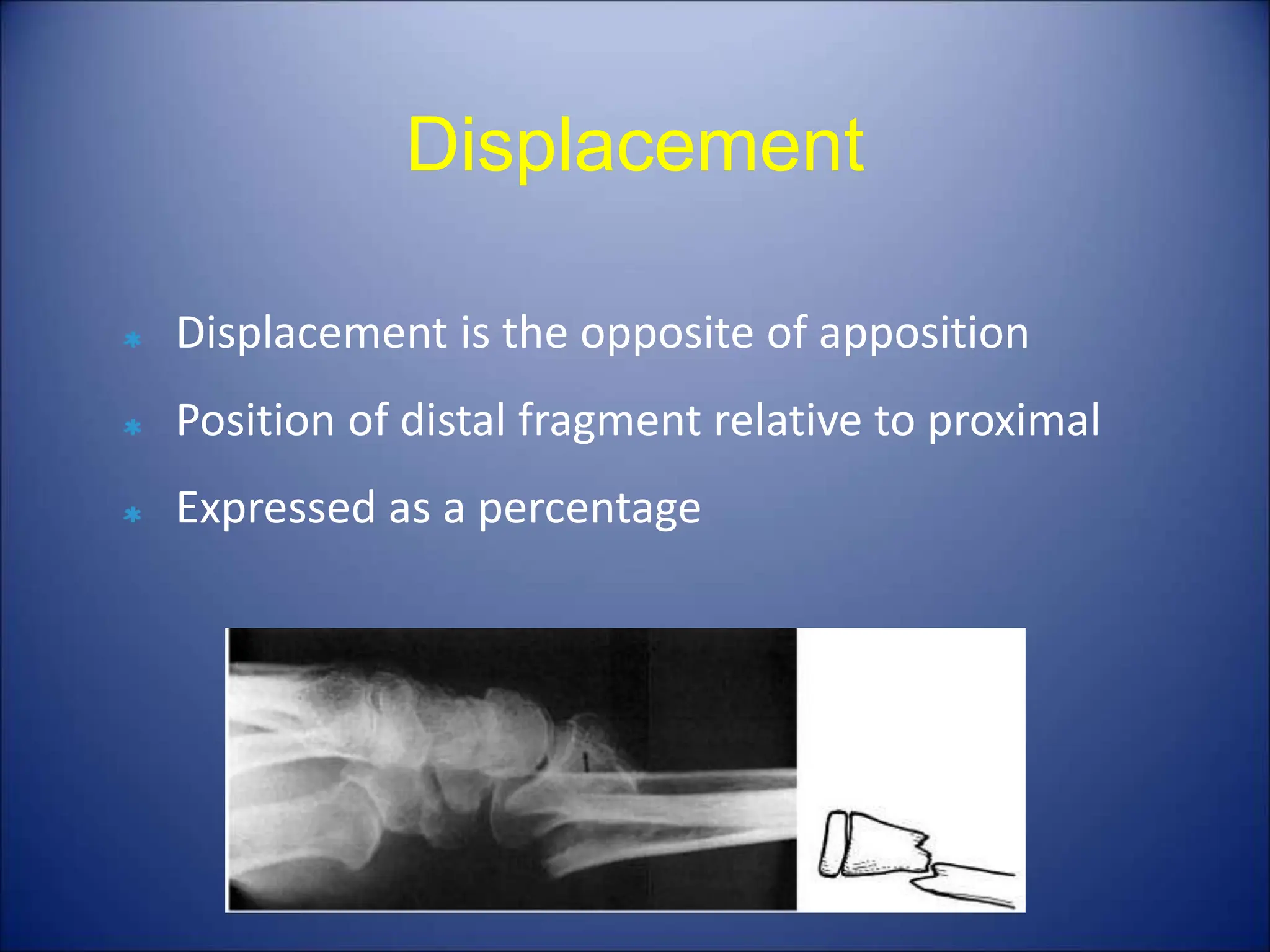 Principles of Fractures. Principle of Fractures | PPT