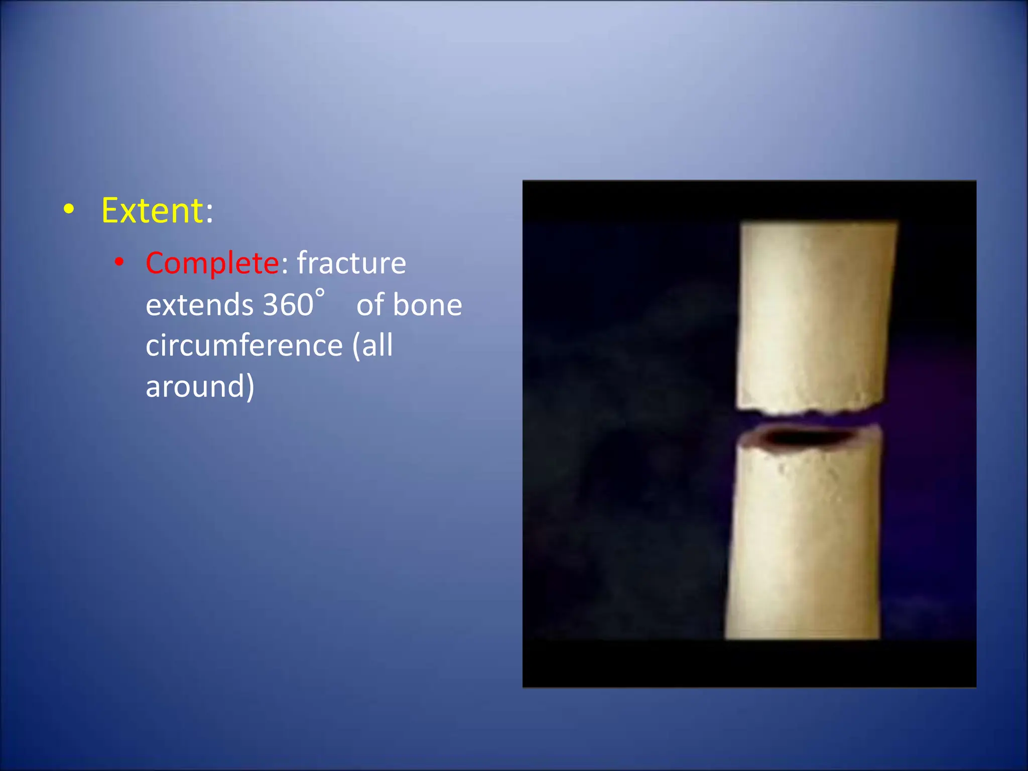 Principles of Fractures. Principle of Fractures | PPT