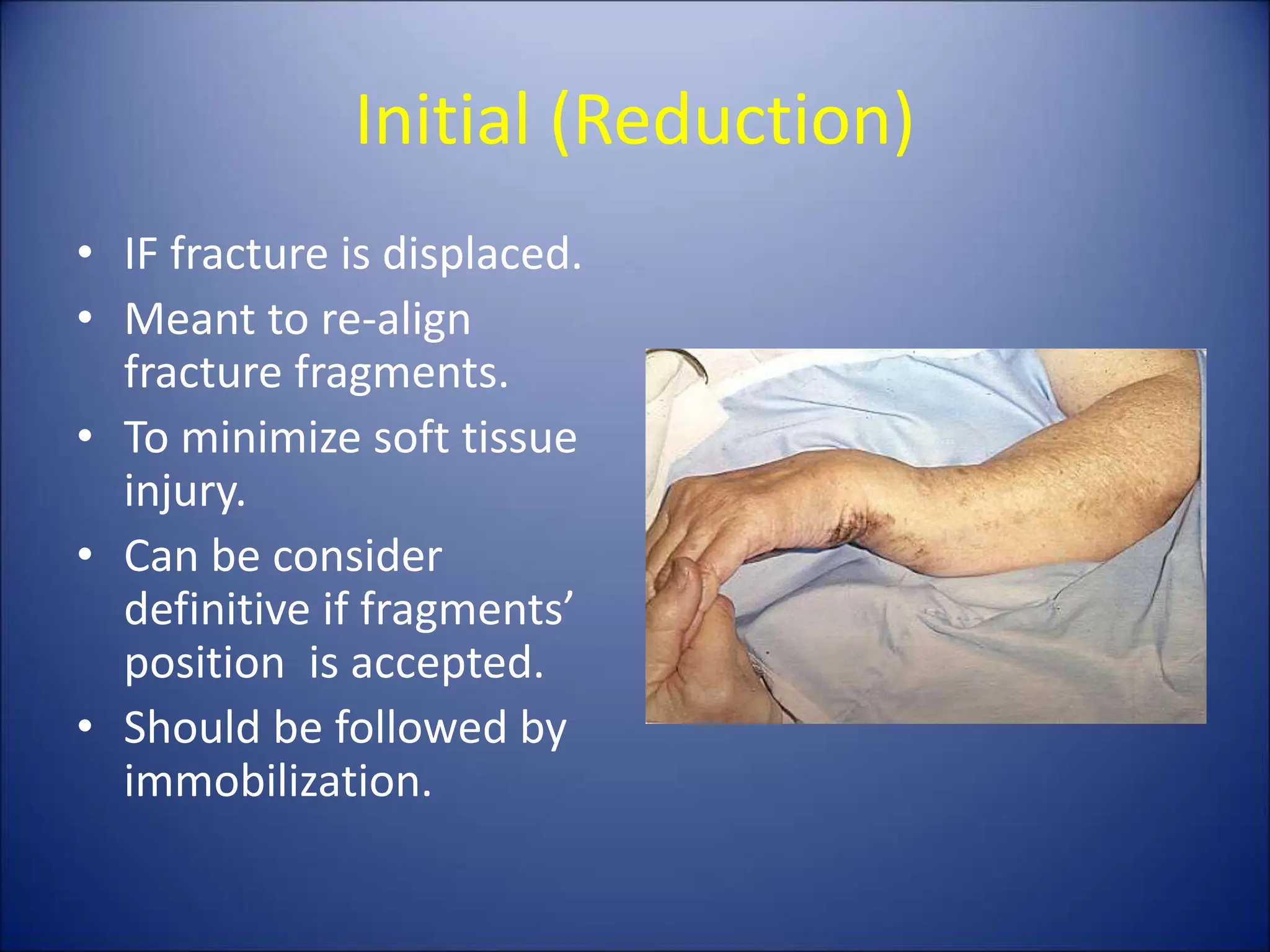 Principles of Fractures. Principle of Fractures | PPT