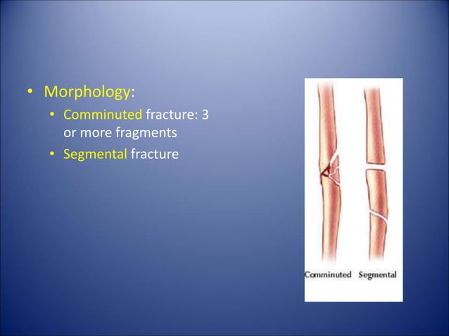Principles of Fractures. Principle of Fractures | PPT