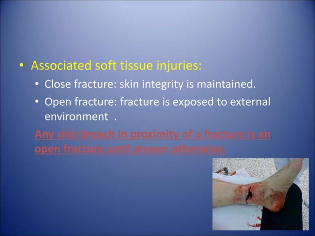Principles of Fractures. Principle of Fractures | PPT