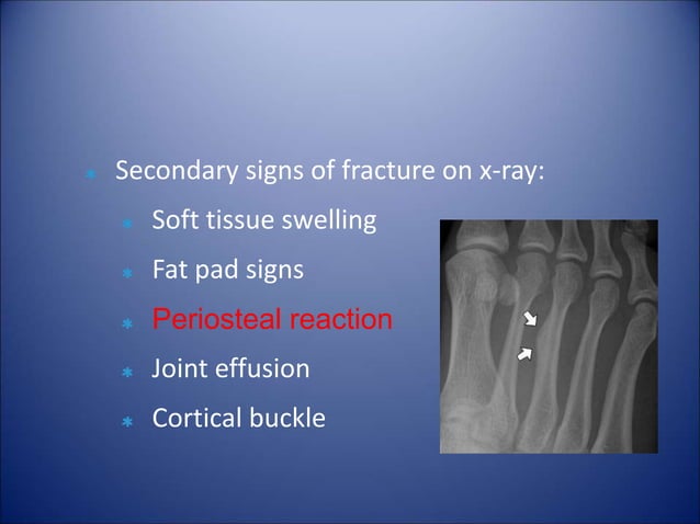 Principles of Fractures. Principle of Fractures | PPT