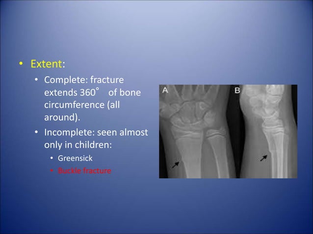 Principles of Fractures. Principle of Fractures | PPT