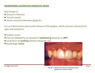 021.acute gingival diseases | PDF