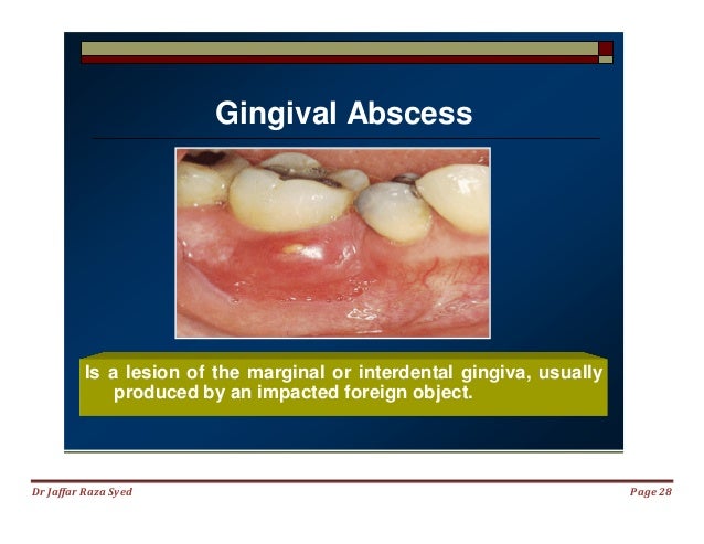 021.acute gingival diseases