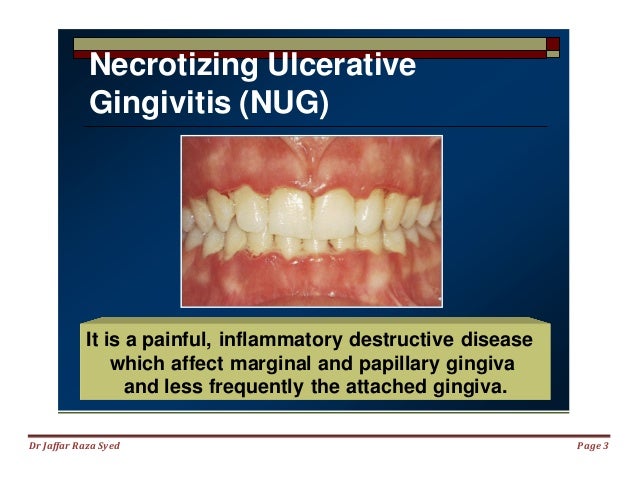 021.acute gingival diseases