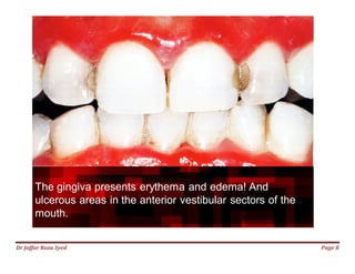 022.desquamative gingivitis | PDF