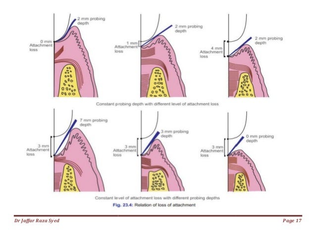 023.periodontal pocket