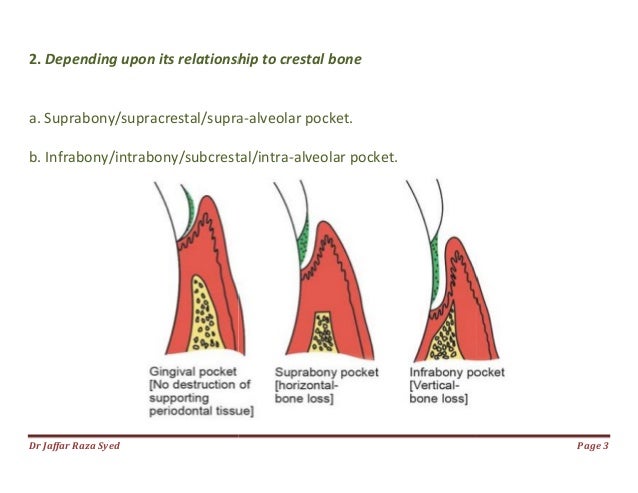 023.periodontal pocket