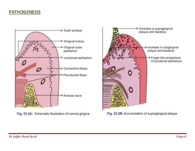 023.periodontal pocket