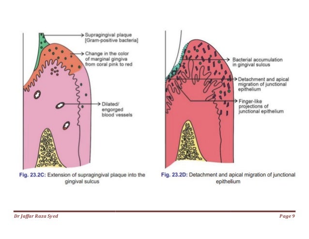 023.periodontal pocket