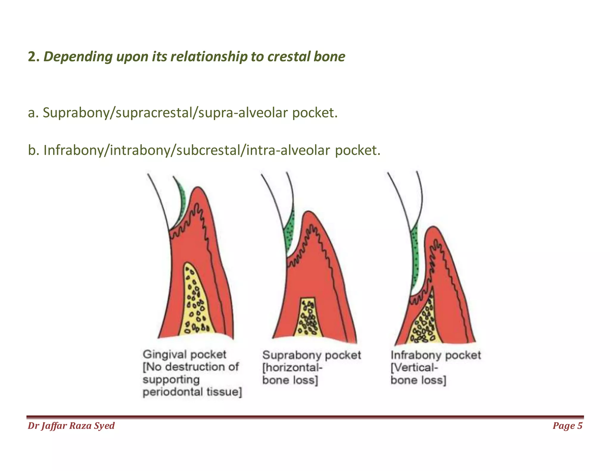 periodontal pocket | DOCX
