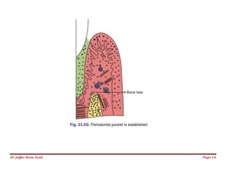 periodontal pocket | DOCX