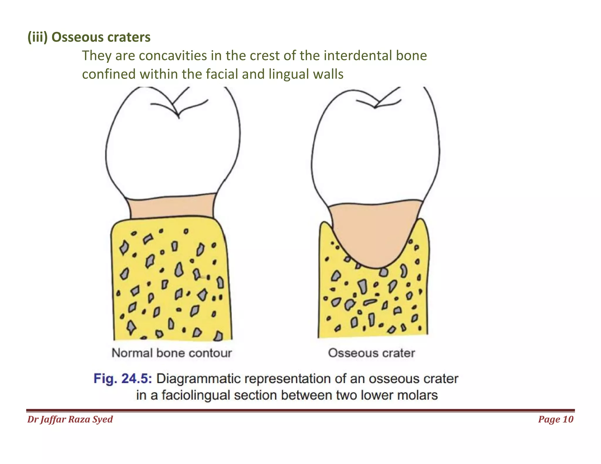 024.bone loss and patterns of bone destruction | PDF