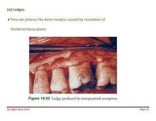 024.bone loss and patterns of bone destruction | PDF | Dental Health ...