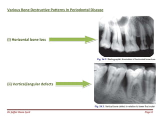 024.bone loss and patterns of bone destruction | PDF | Dental Health ...