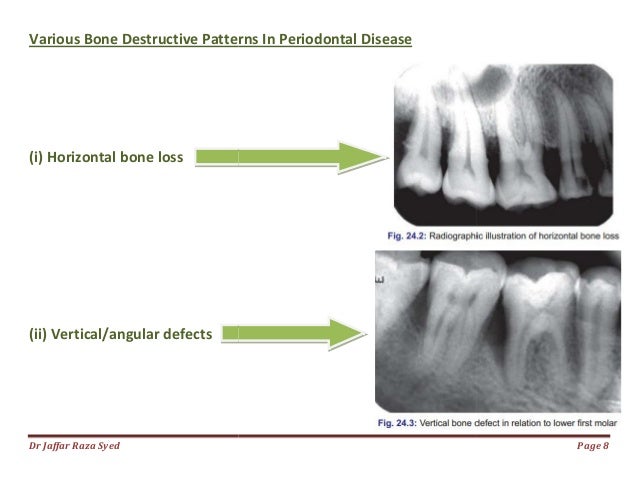 024.bone loss and patterns of bone destruction