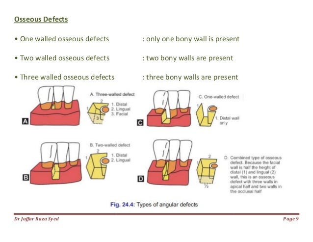 024.bone loss and patterns of bone destruction