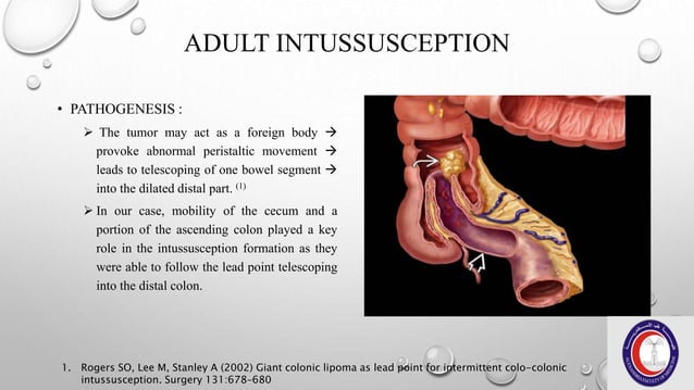 Subserosal Cecal Lipoma A Rare Cause Of Ileo Colic Intussusception In Adults
