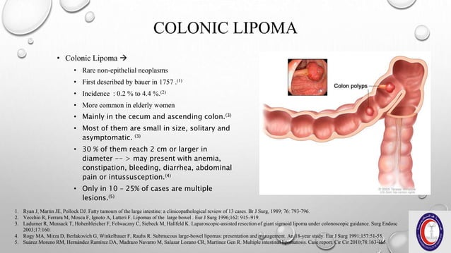 Subserosal Cecal Lipoma : A rare Cause of Ileo-colic Intussusception in ...