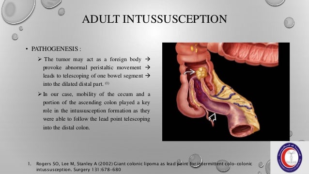 Subserosal Cecal Lipoma : A rare Cause of Ileo-colic Intussusception…