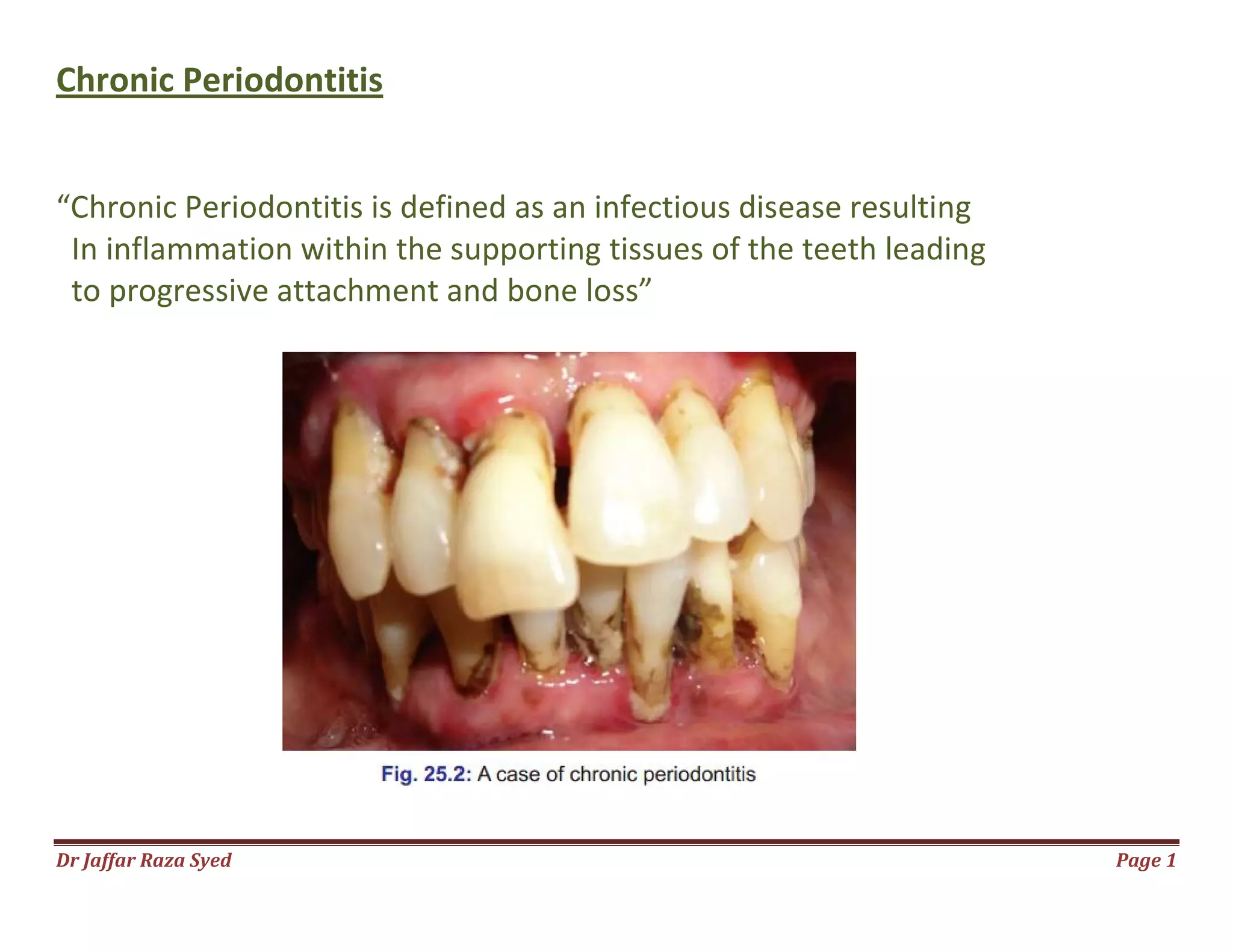 025.chronic periodontitis | PDF