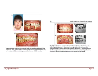 Necrotizing Ulcerative Periodontitis Nup