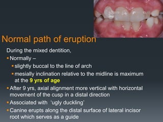 027 Ectopic Eruption of Max Canine.pdfiii | PDF