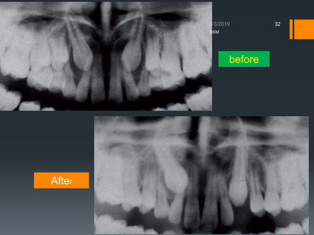027 Ectopic Eruption of Max Canine.pdfiii | PDF