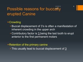 027 Ectopic Eruption of Max Canine.pdfiii | PDF