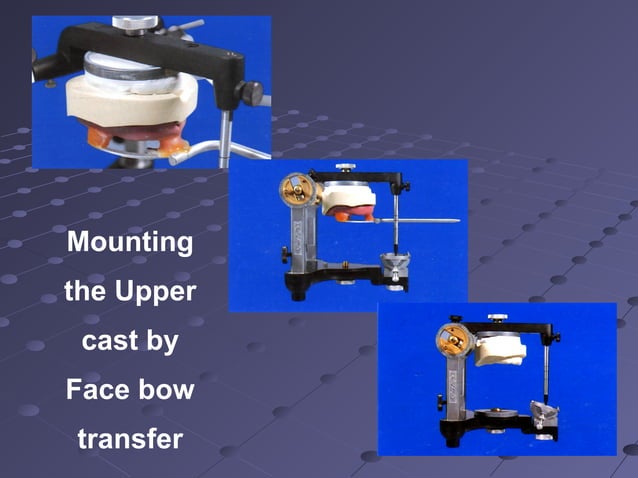 02 FACE BOWS AND ARTICULATORS | PPT | Dental Health | Diseases and ...