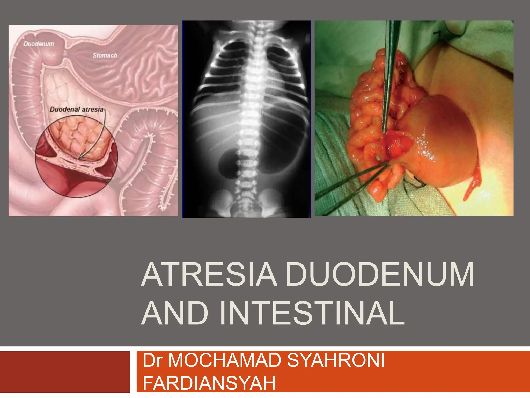 (02) Atresia Duodenum and management.ppt