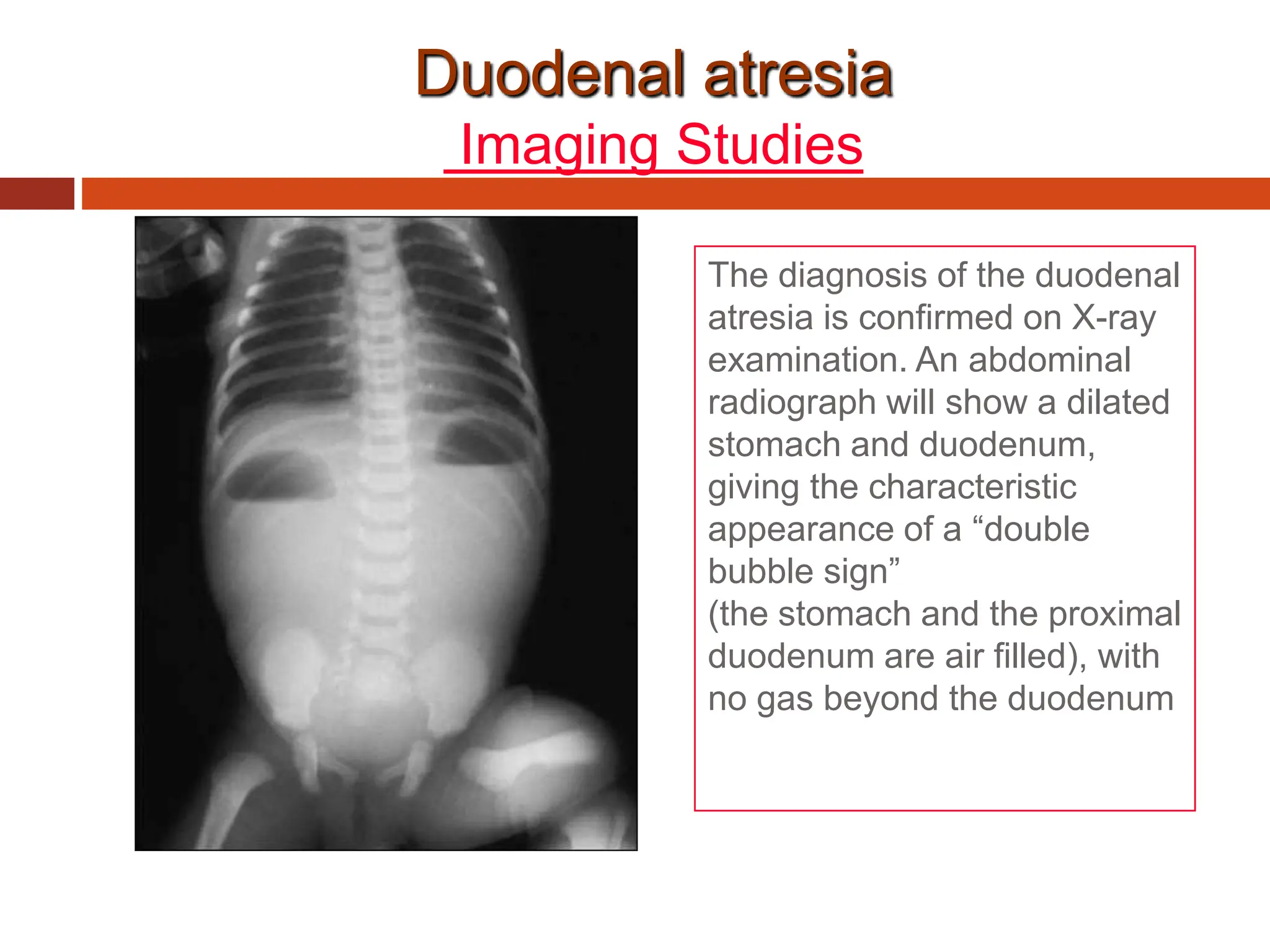 (02) Atresia Duodenum and management.ppt