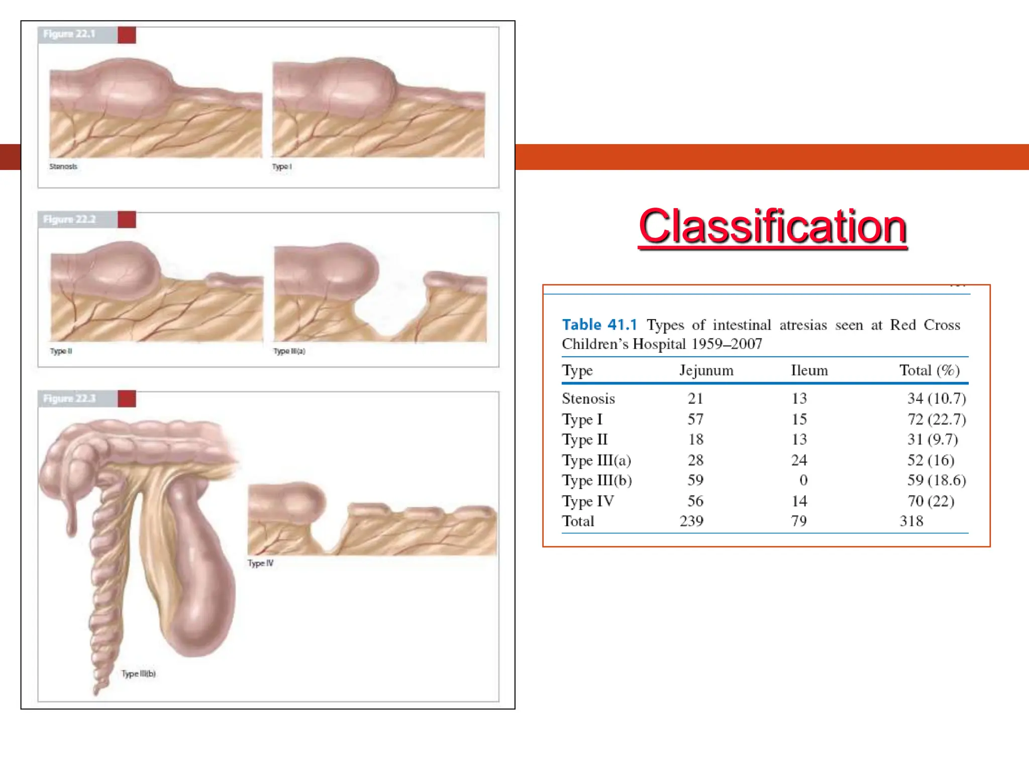 (02) Atresia Duodenum and management.ppt