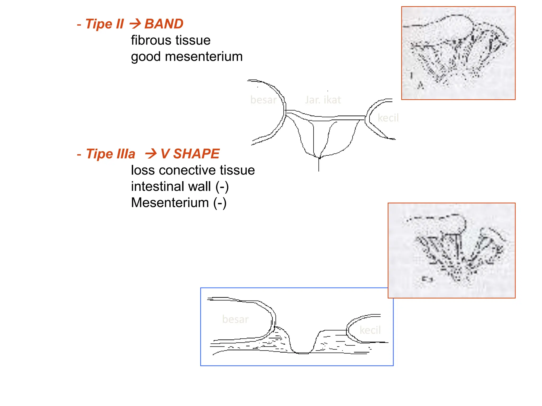 (02) Atresia Duodenum and management.ppt
