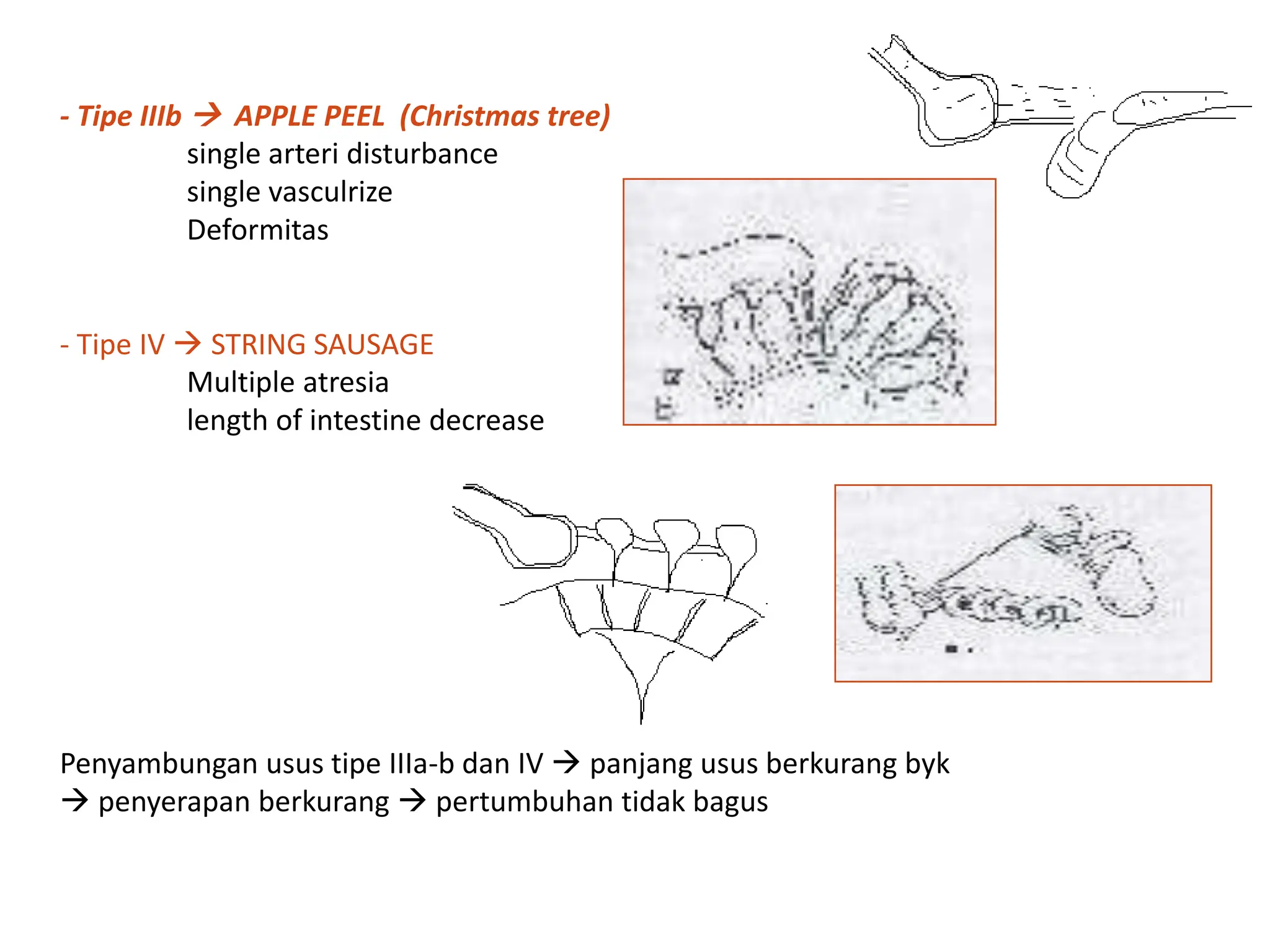 (02) Atresia Duodenum and management.ppt