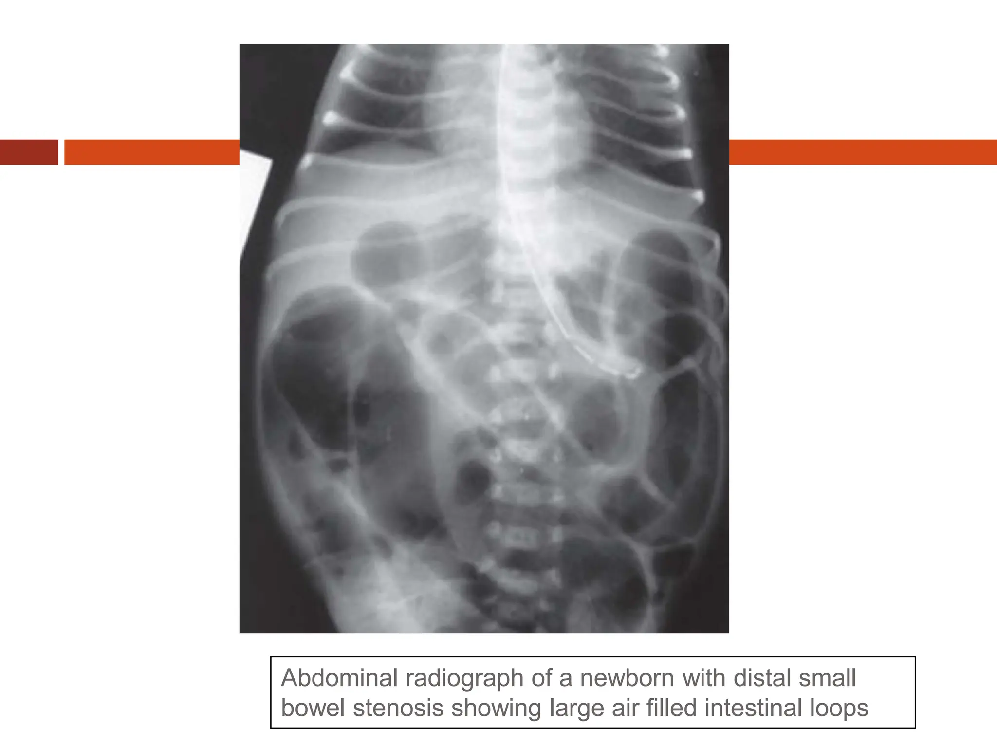 (02) Atresia Duodenum and management.ppt