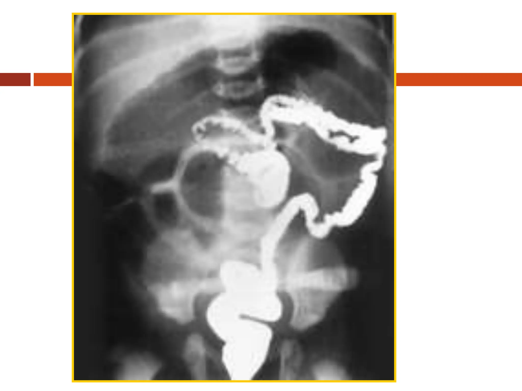 (02) Atresia Duodenum and management.ppt