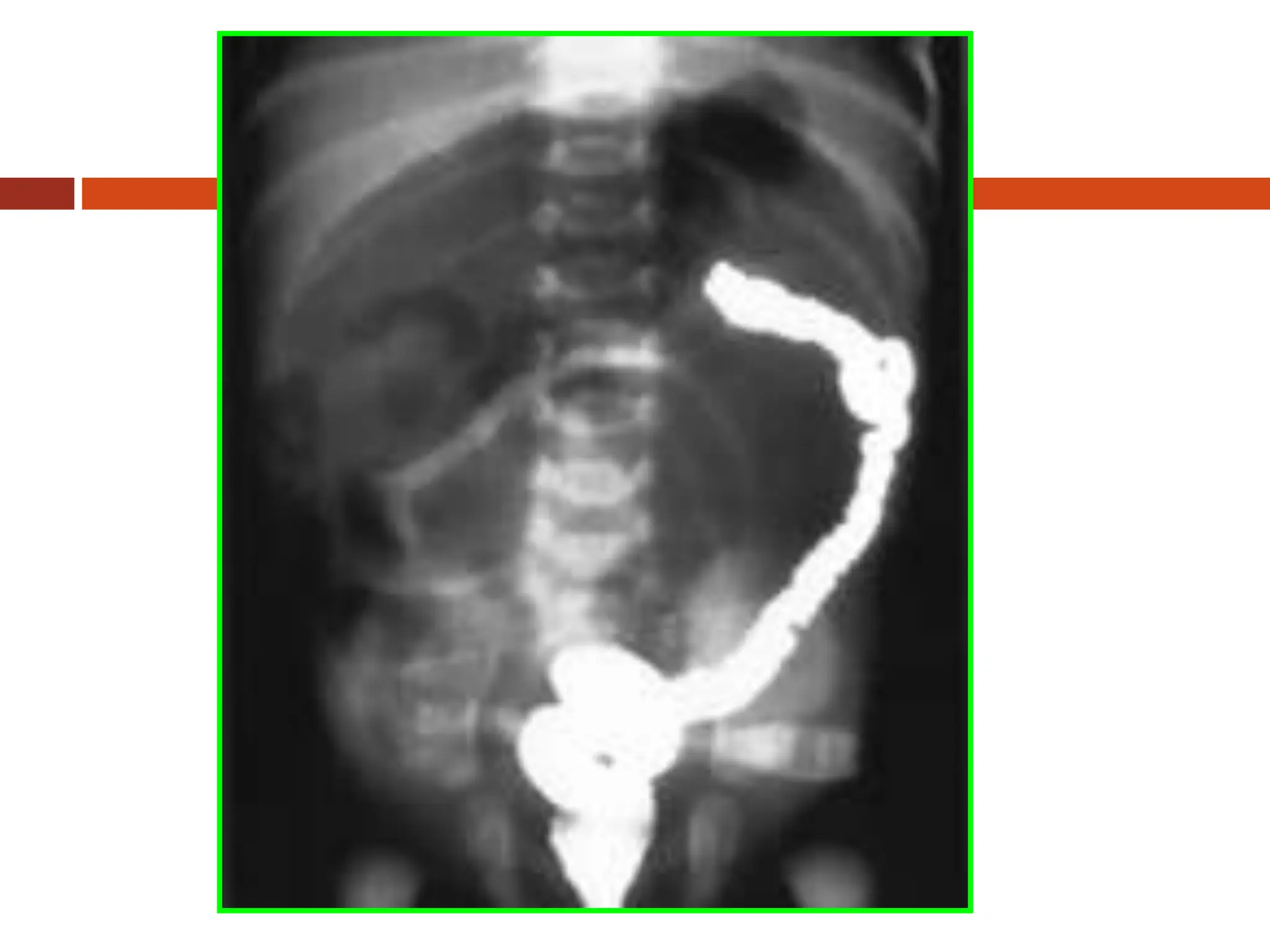 (02) Atresia Duodenum and management.ppt