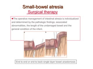 (02) Atresia Duodenum and management.ppt