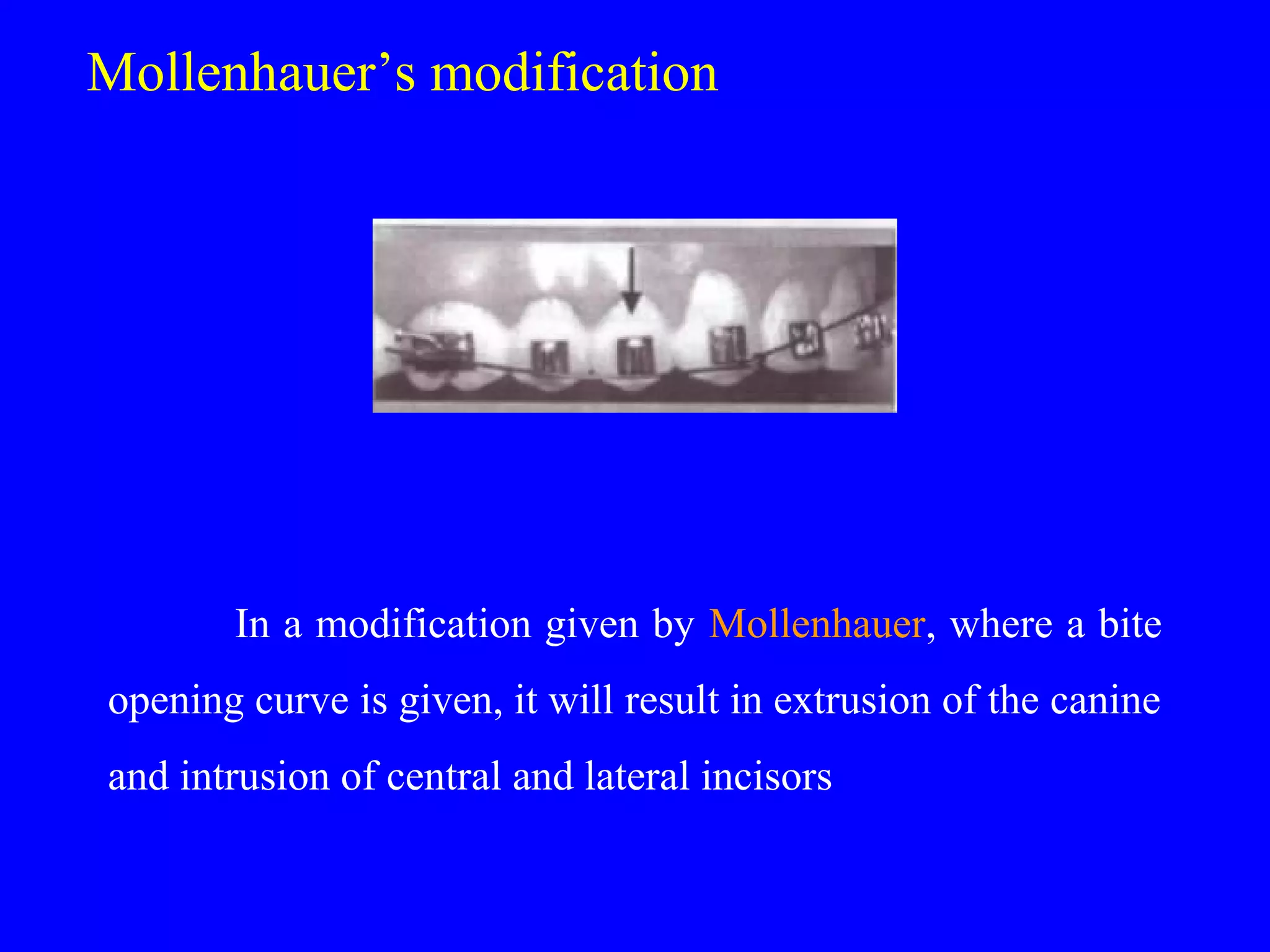 beggs technique bends | PPT