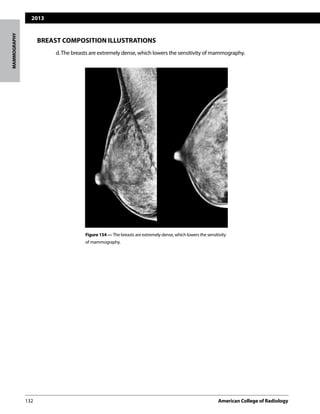 02 birads mammography reporting | PDF