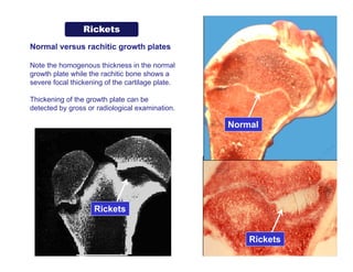 02_disease of bone_metabolic general.pdf