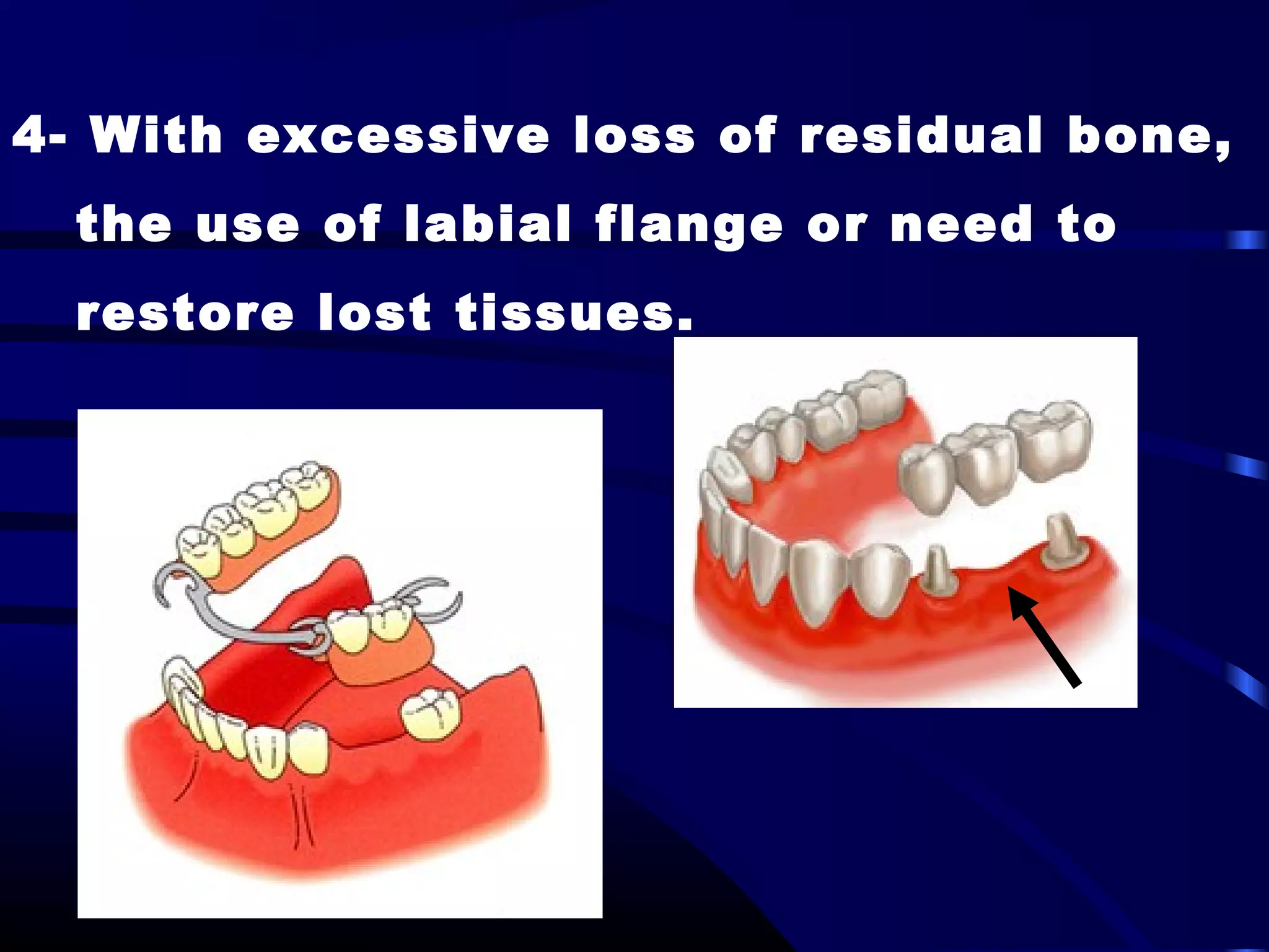 02 classification and indications of rpd | PPT