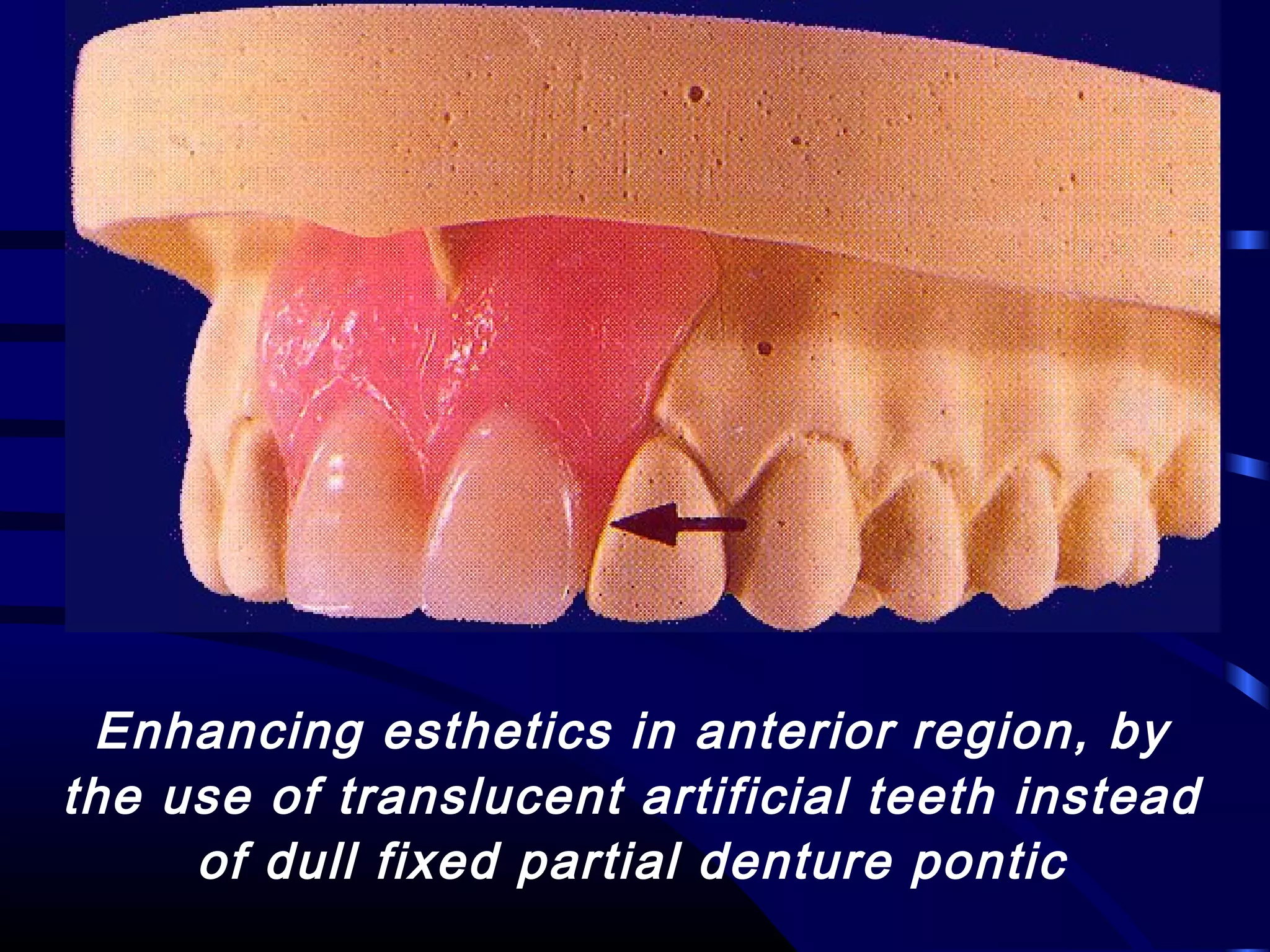 02 classification and indications of rpd | PPT