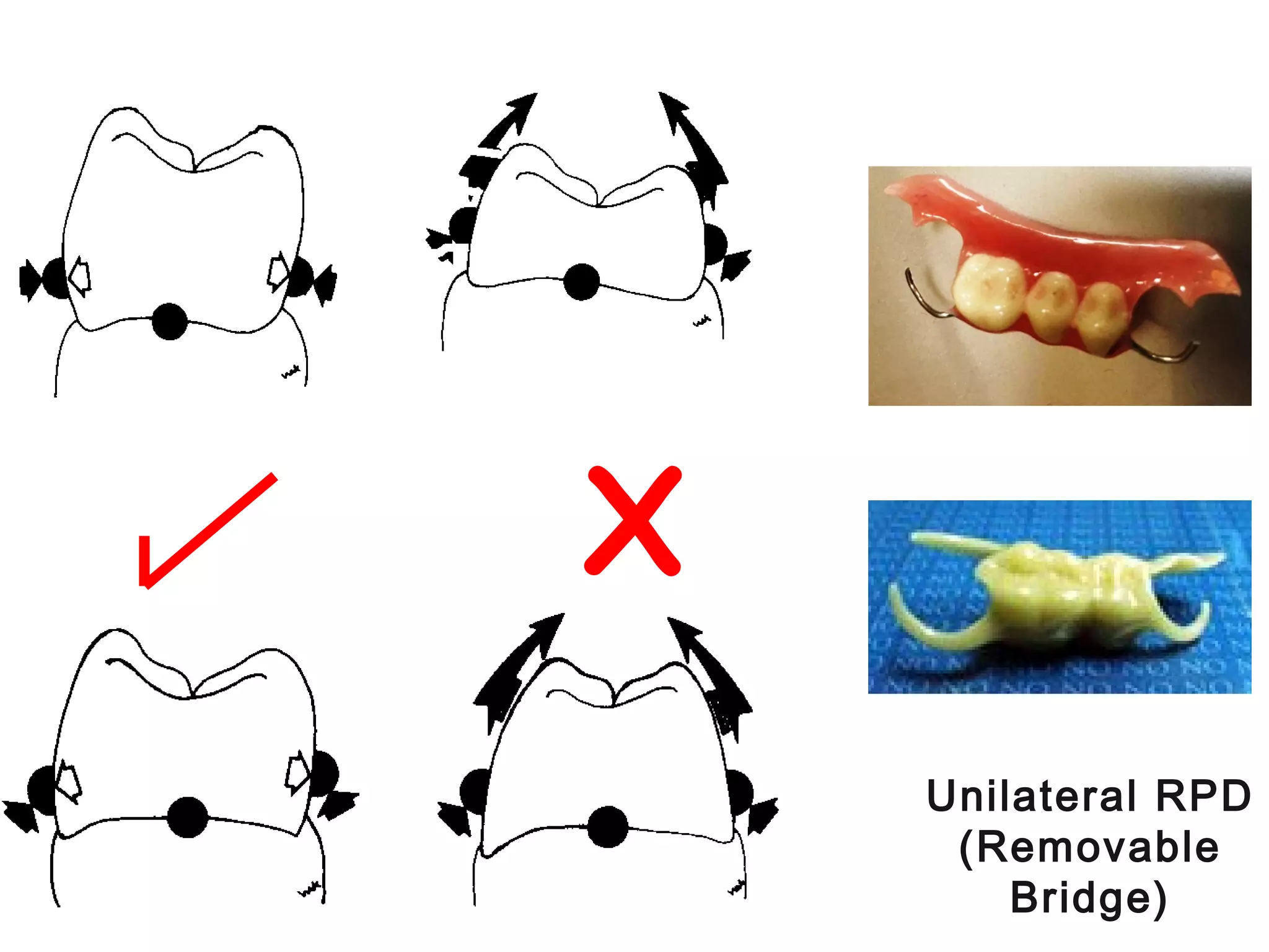 02 classification and indications of rpd | PPT