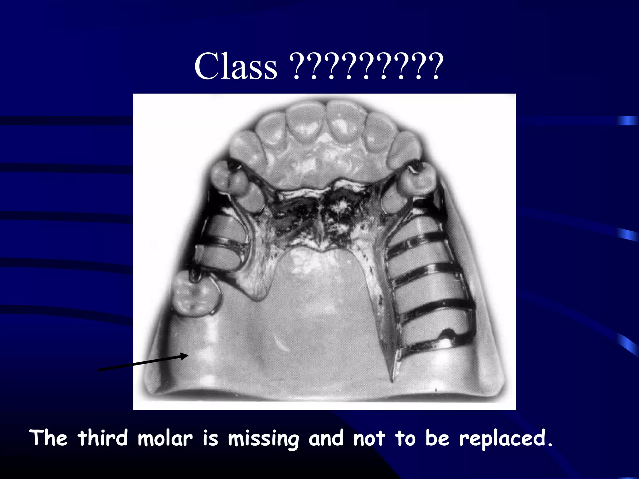 02 classification and indications of rpd | PPT