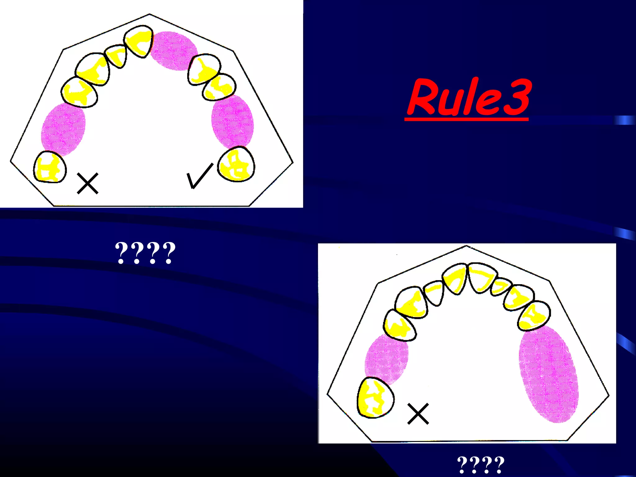 02 classification and indications of rpd | PPT