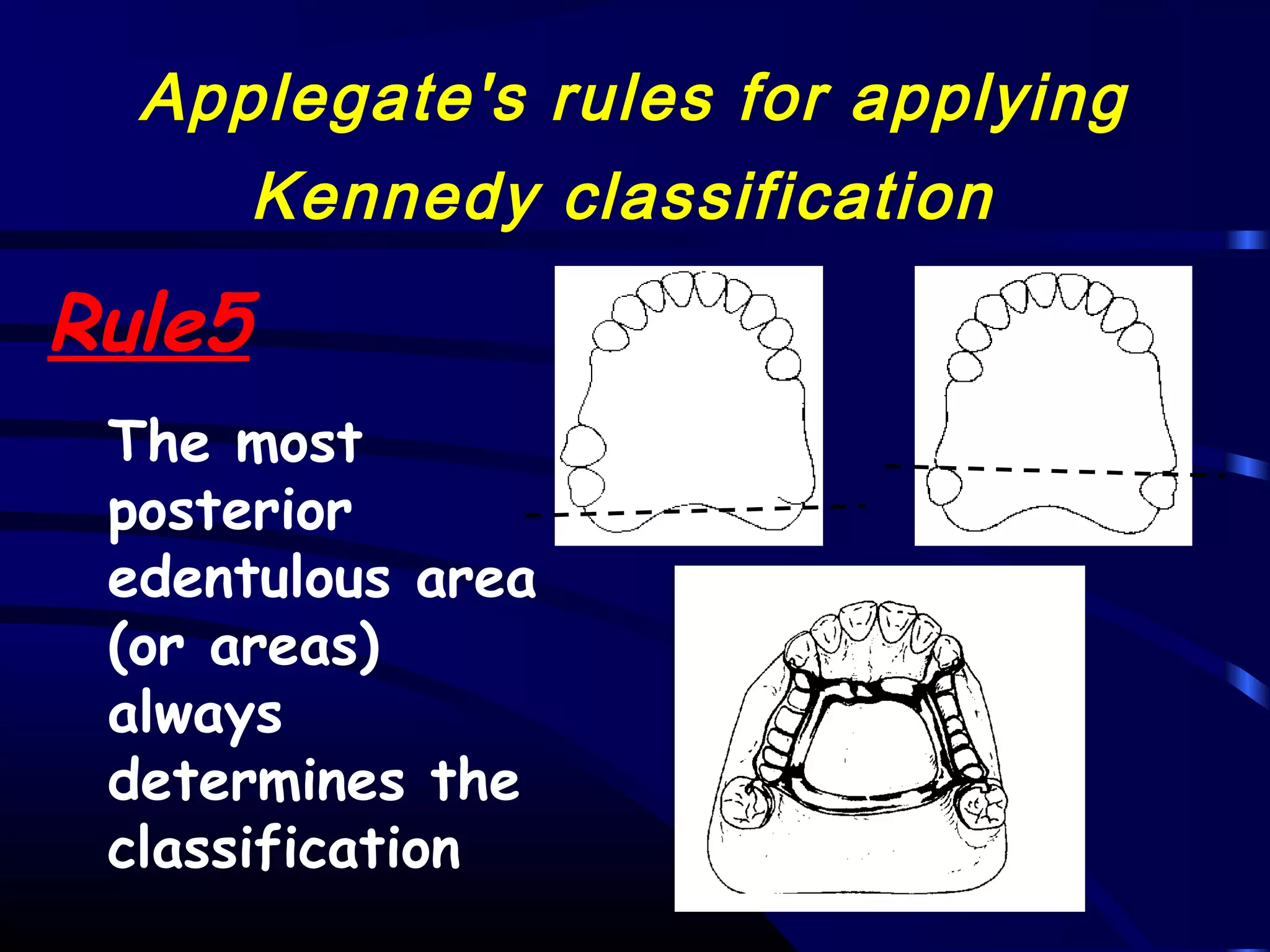 02 classification and indications of rpd | PPT