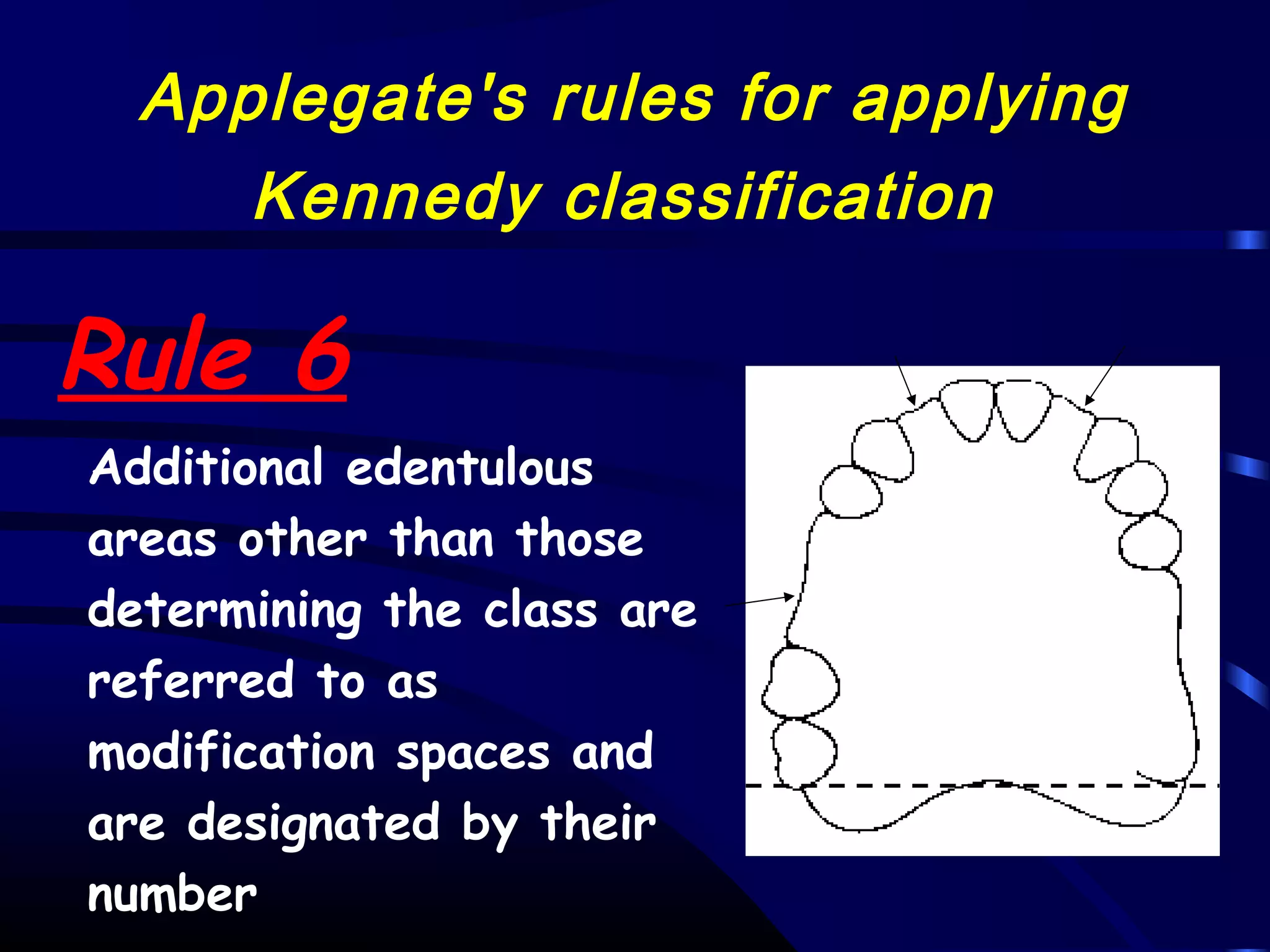 02 classification and indications of rpd | PPT